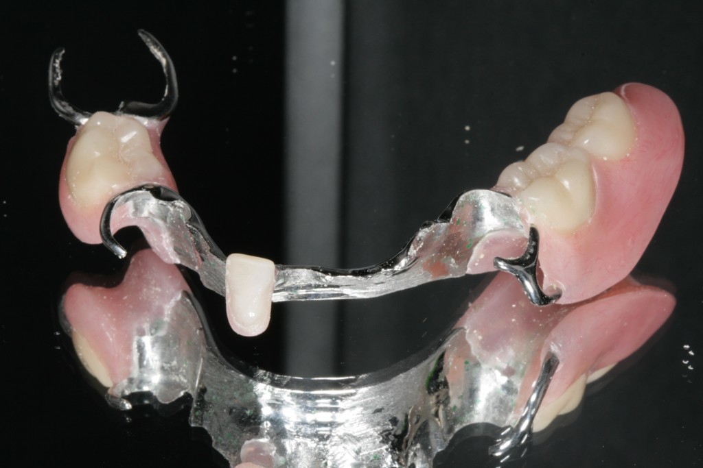 Cast Metal Partials - Family and Cosmetic Dentist in Seneca, SC - Josh ...