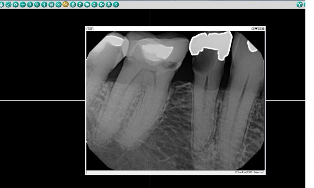 Digital Dental Radiography - Family and Cosmetic Dentist in Seneca, SC ...